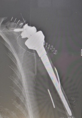 Salvage Reverse Shoulder Arthroplasty for Failed Proximal Humeral ...