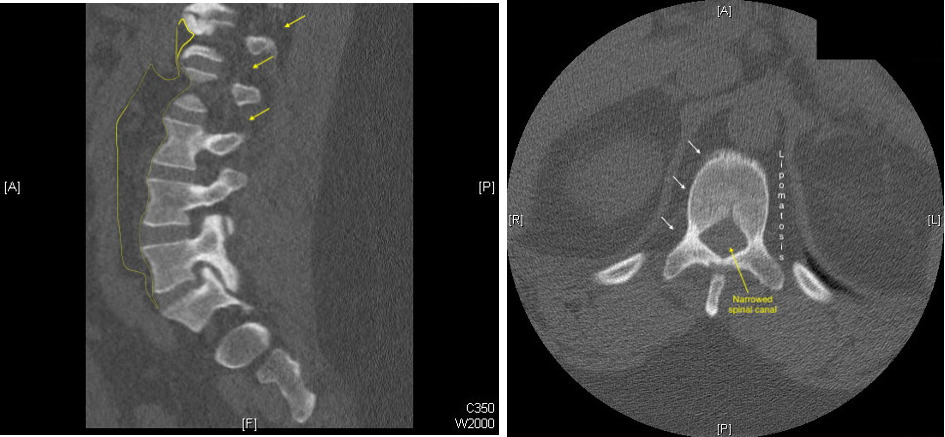 Bilateral Lower Extremity Weakness Spinal Epidural Lipomatosis Or More 