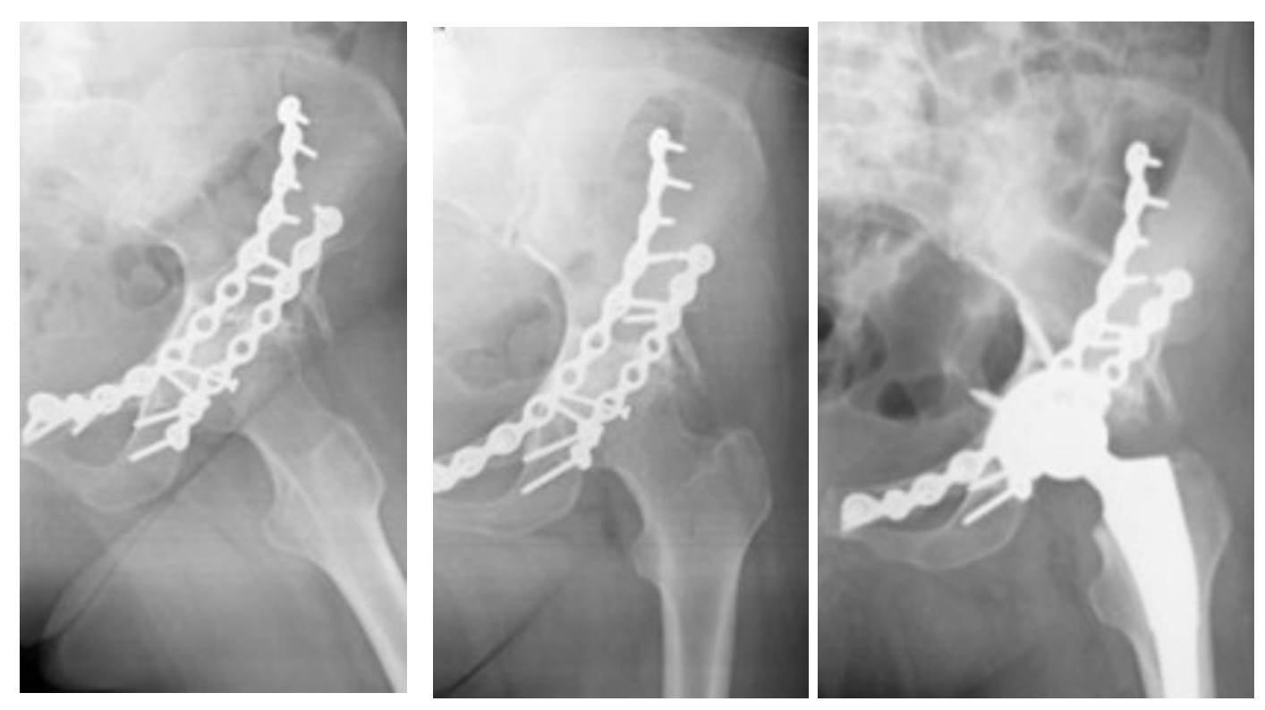 Acetabulum Acetabulum
